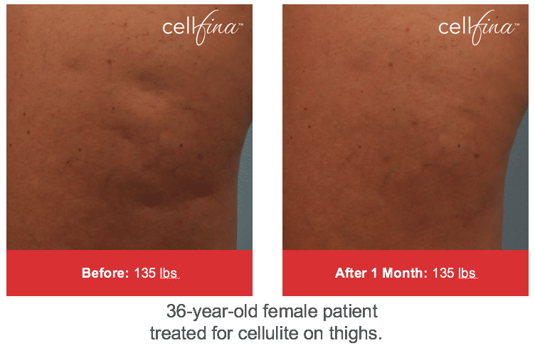 Cellfina Cellulite Treatment in San Antonio TX | Dr. Vivian Bucay