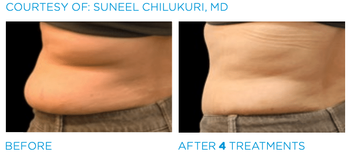 Cellutone San Antonio | Body Contouring | Skin Tightening TX