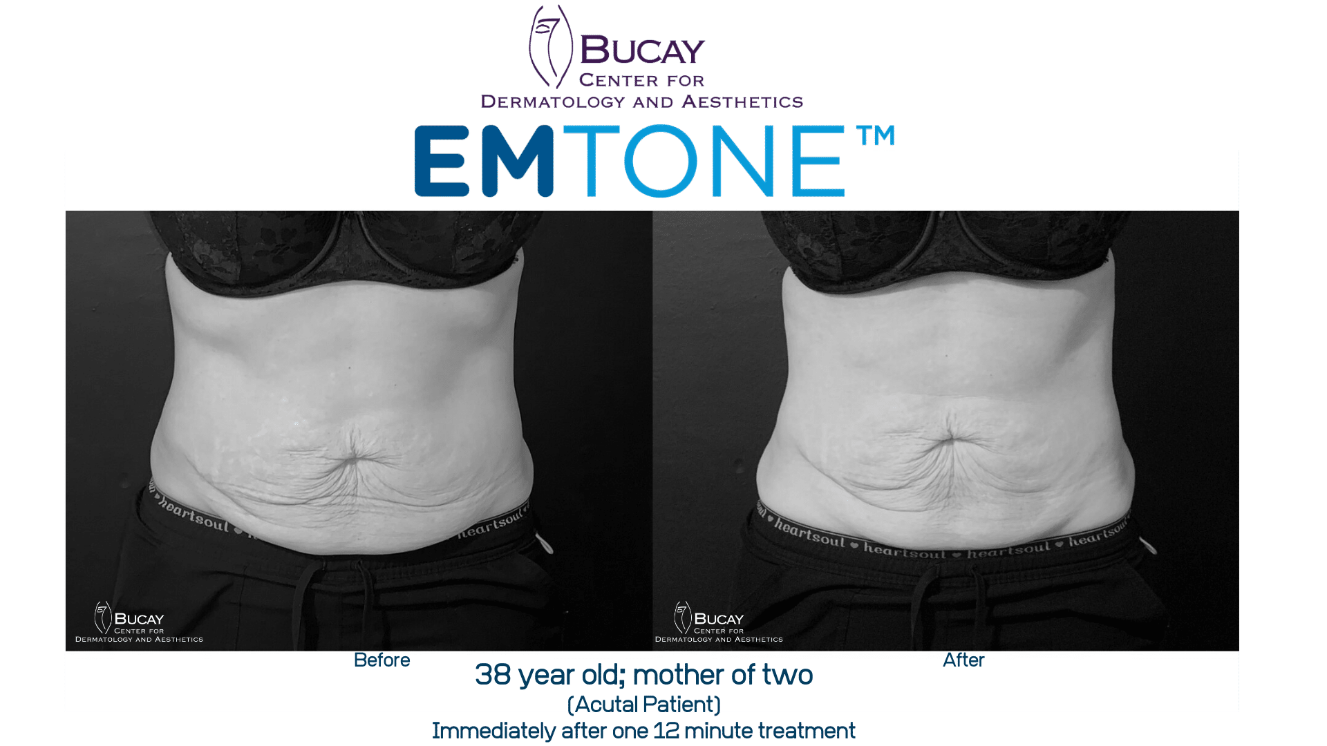 Emtone, Non-Surgical Skin Tightening San Antonio, TX | Dr. Vivian Bucay