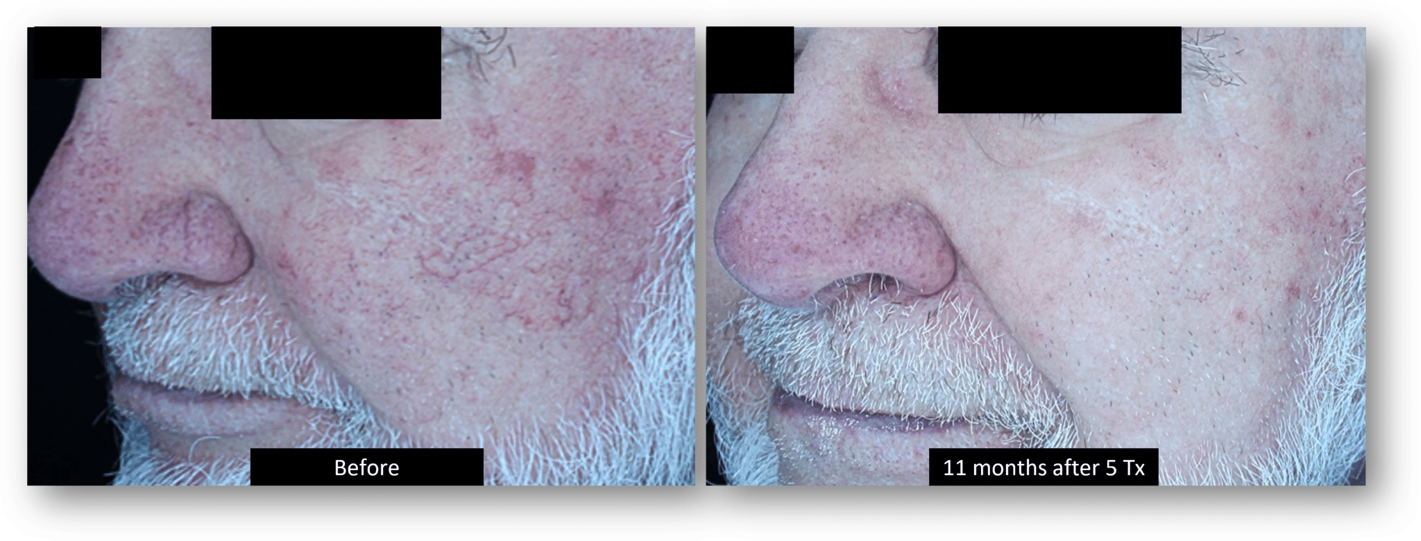 Lutronic’s DermaV Treatment San Antonio & Stone Oak TX