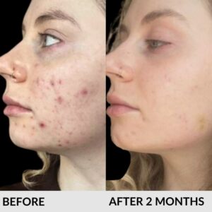 AO2 Clear San Antonio TX - Acne Treatment Solution Stone Oak