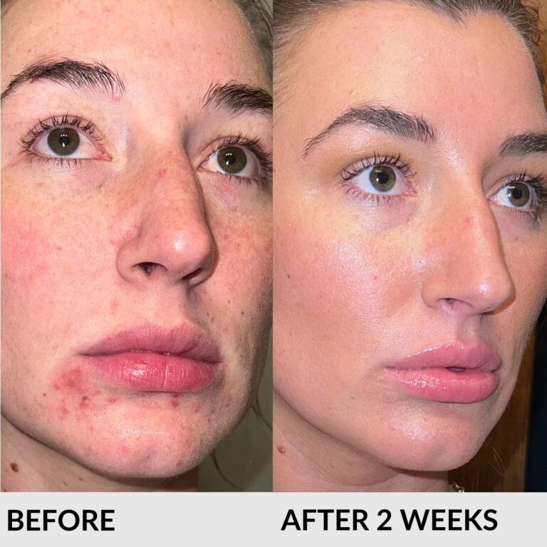 AO2 Clear San Antonio TX - Acne Treatment Solution Stone Oak