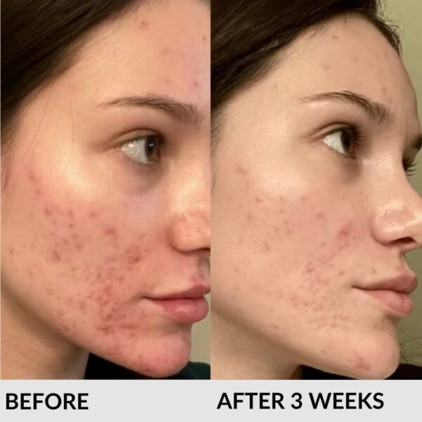 AO2 Clear San Antonio TX - Acne Treatment Solution Stone Oak
